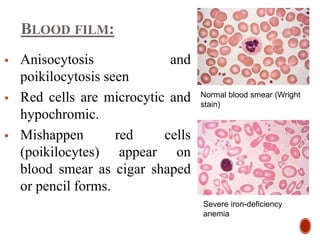 Iron deficiency anemia | PPTX