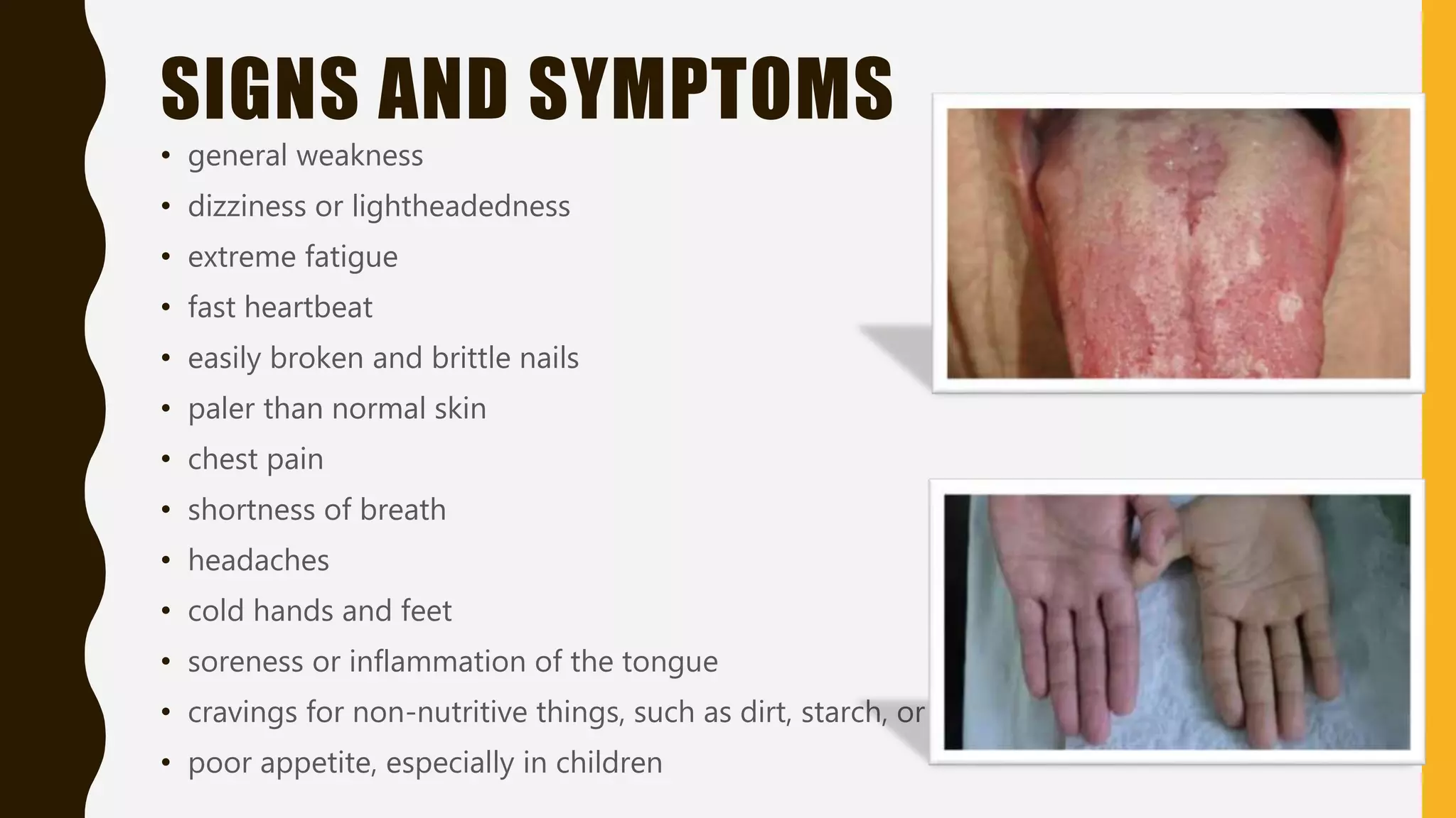 Iron deficiency anemia | PPTX