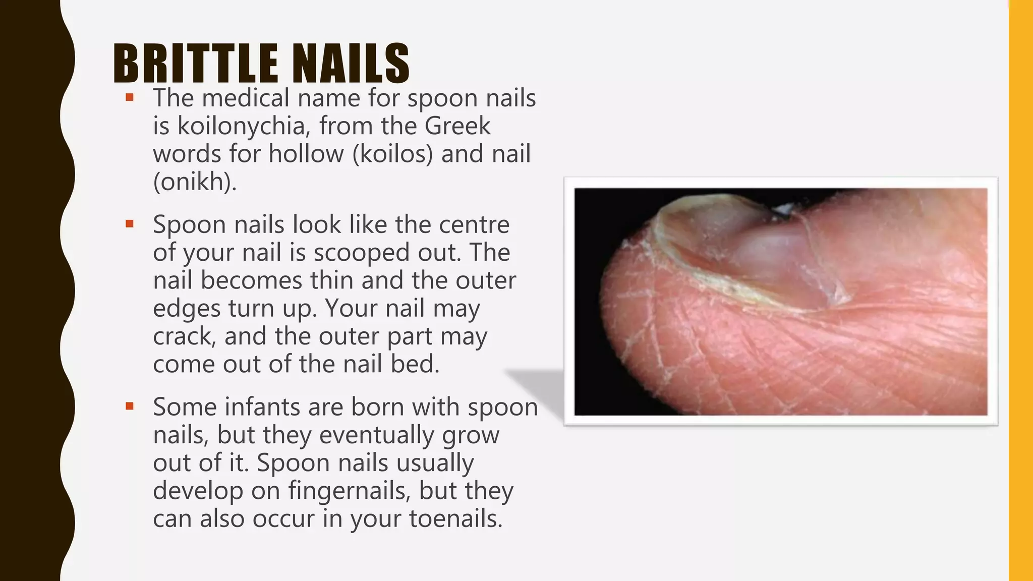 Iron deficiency anemia | PPTX