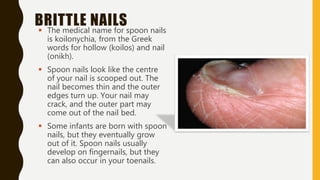 Iron deficiency anemia | PPTX