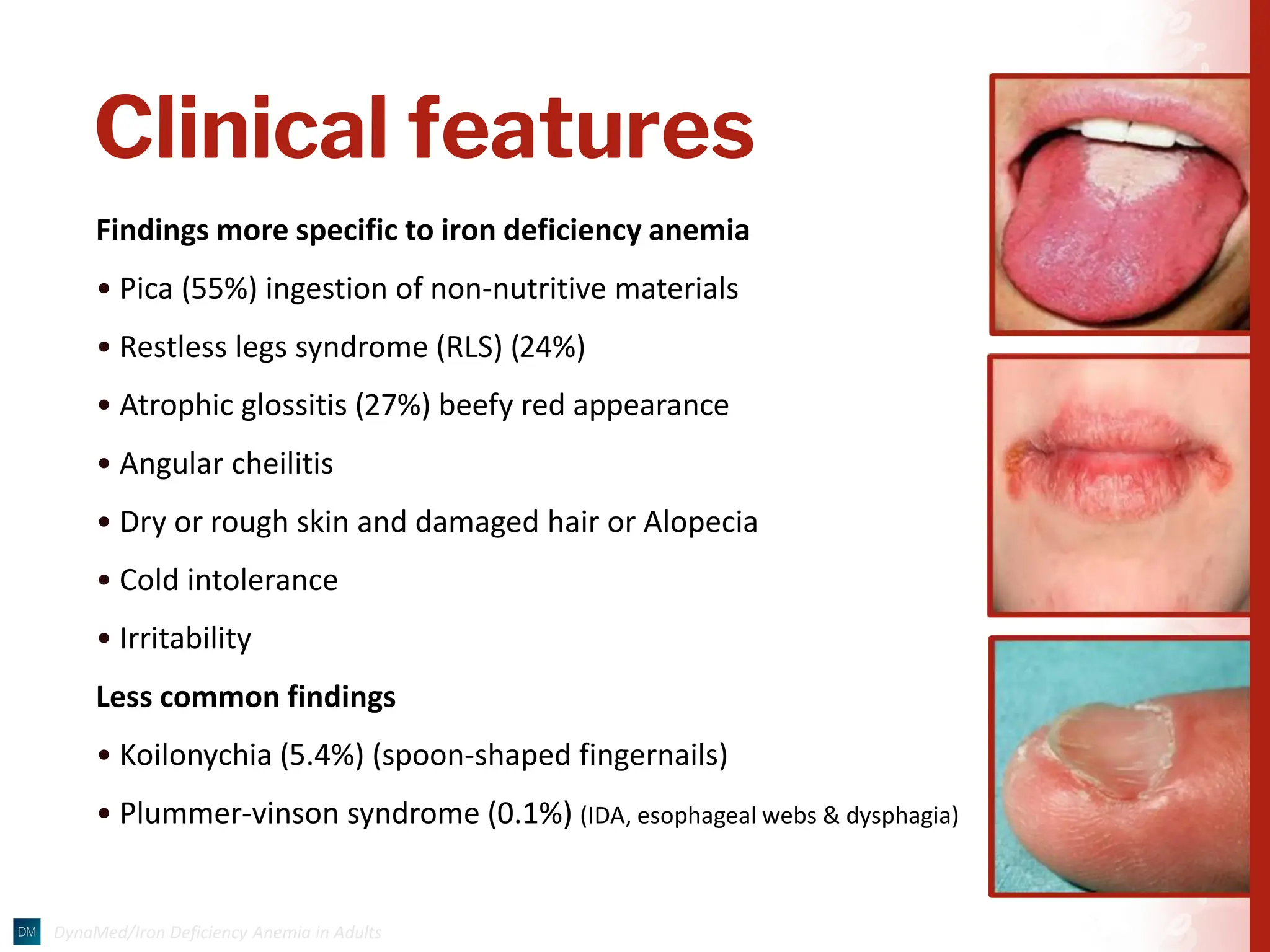 Iron deficiency anemia (IDA) Diagnosis & Management | PPT