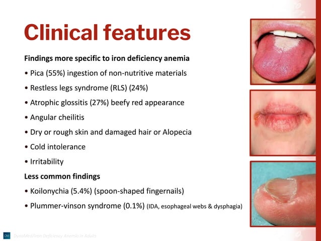 Iron deficiency anemia (IDA) Diagnosis & Management | PPT