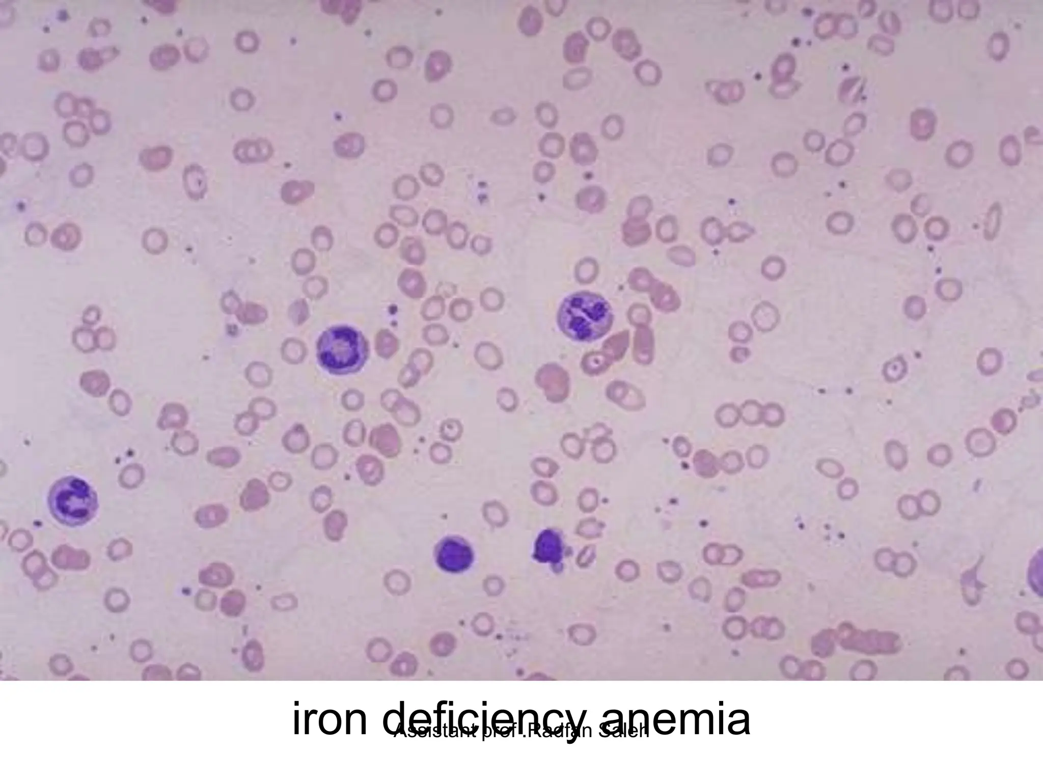 iron deficiency anemia for laboratory students.ppt