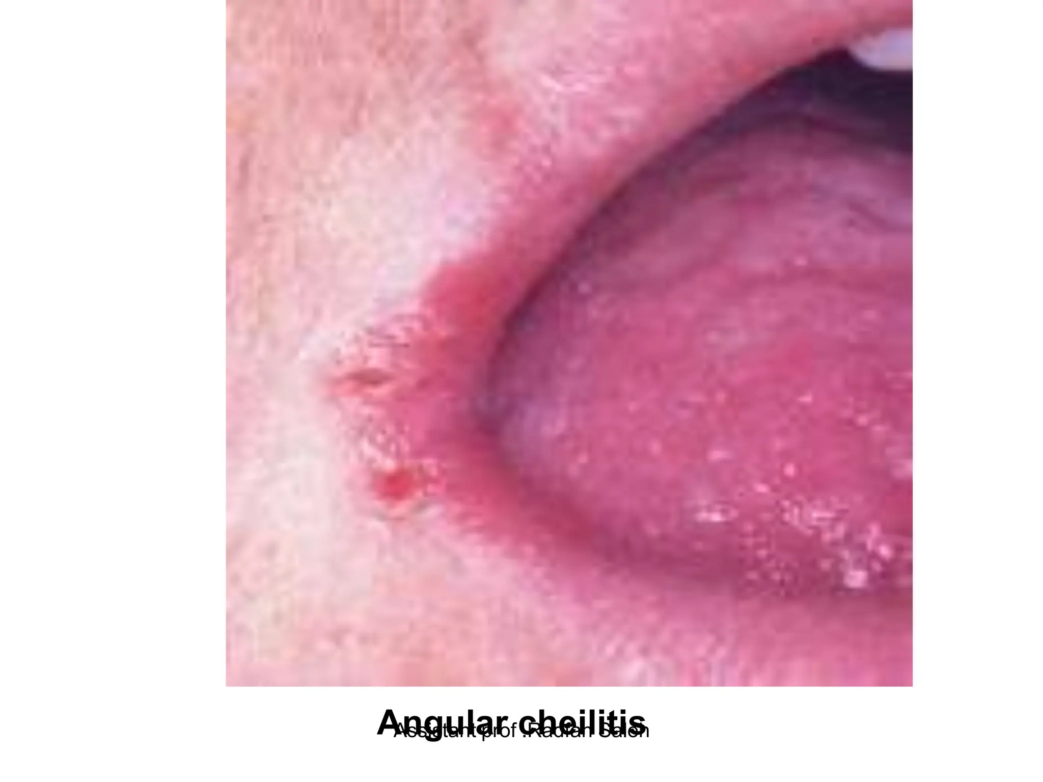 iron deficiency anemia for laboratory students.ppt