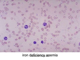 iron deficiency anemia for laboratory students.ppt