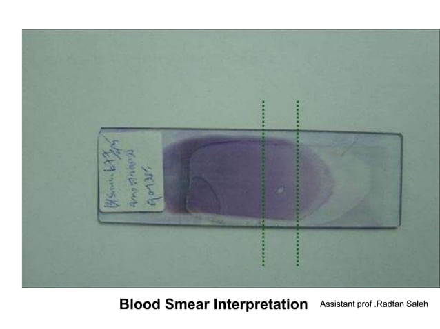 iron deficiency anemia for laboratory students.ppt