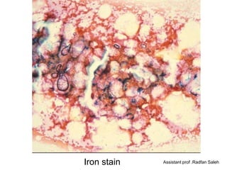 iron deficiency anemia for laboratory students.ppt