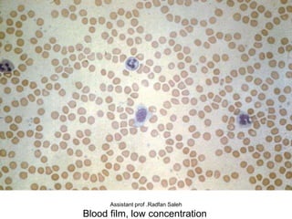 iron deficiency anemia for laboratory students.ppt