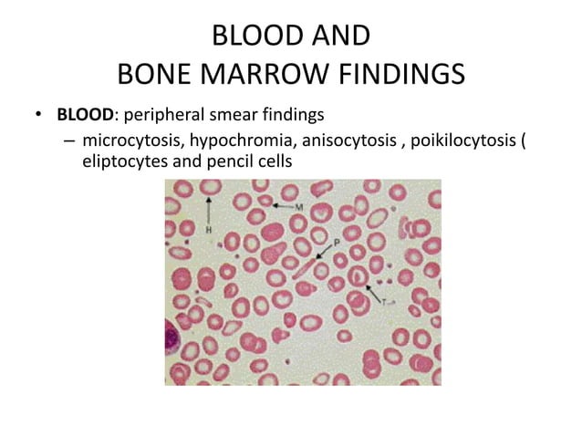 Iron deficiency anemia pathogenesis and lab diagnosis | PPTX | Blood ...