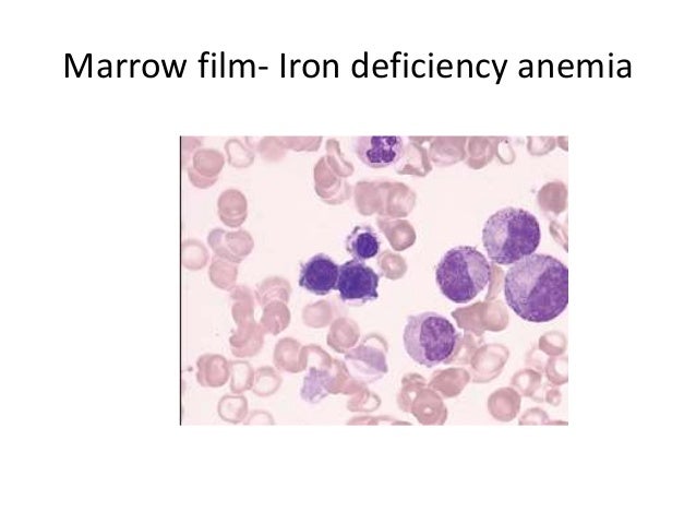 Iron deficiency anemia pathogenesis and lab diagnosis