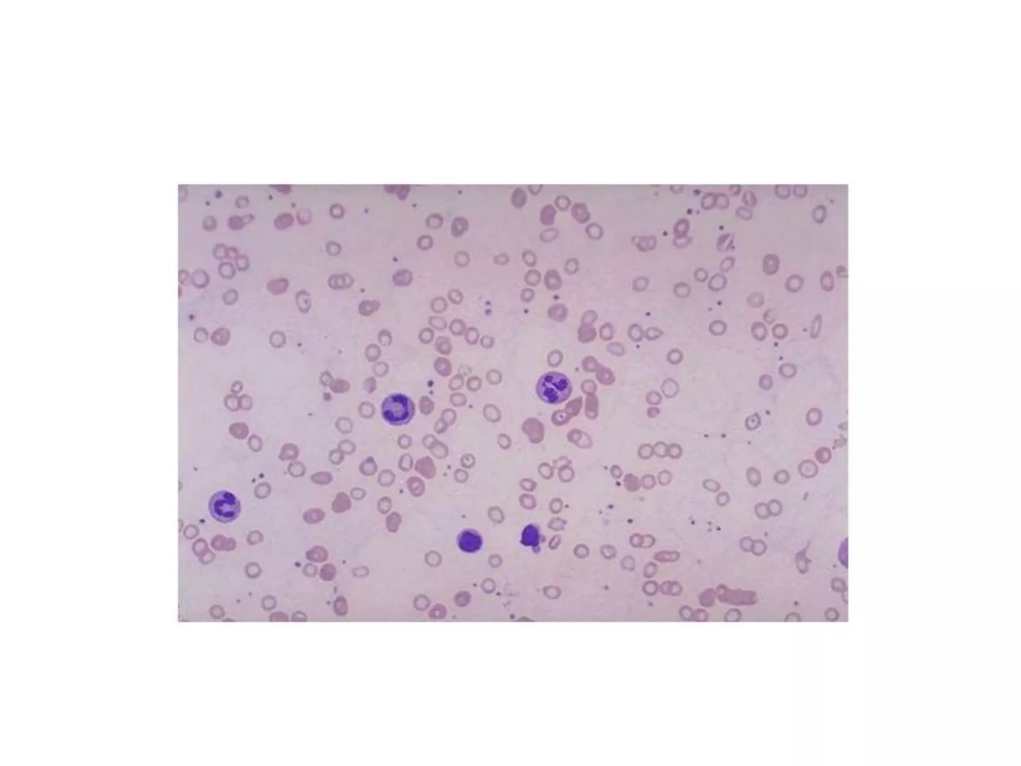 IRON DEFICIENCY ANEMIA AND ITS LAB DIAGNOSIS.pptx