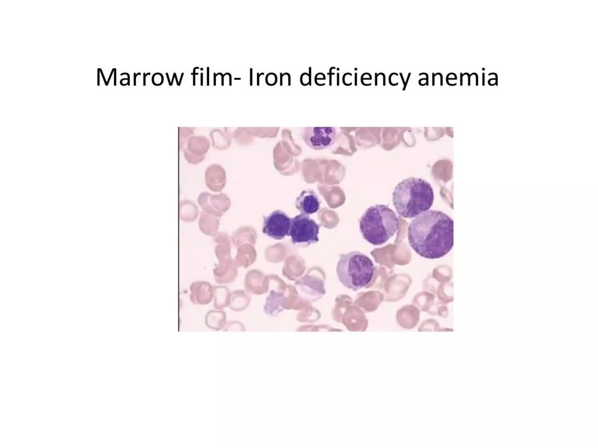 IRON DEFICIENCY ANEMIA AND ITS LAB DIAGNOSIS.pptx