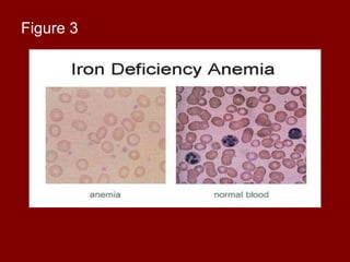 Iron Deficiency Anemia Slide