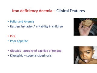 Iron Deficiency Anemia In Children