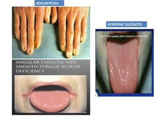 iron deficiency anemia &Iron poisoning.pptx