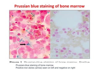 iron deficiency anemia &Iron poisoning.pptx