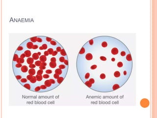 Iron Deficiency Anemia - FCM in brief.pptx