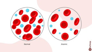 Iron Deficiency Anemia Template by EaTemp.pptx