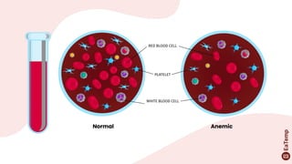 Iron Deficiency Anemia Template by EaTemp.pptx
