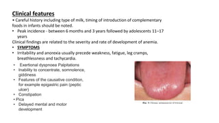 IRON DEFIDIENCY ANEMIA (1.).pptx