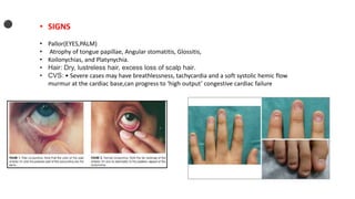 IRON DEFIDIENCY ANEMIA (1.).pptx