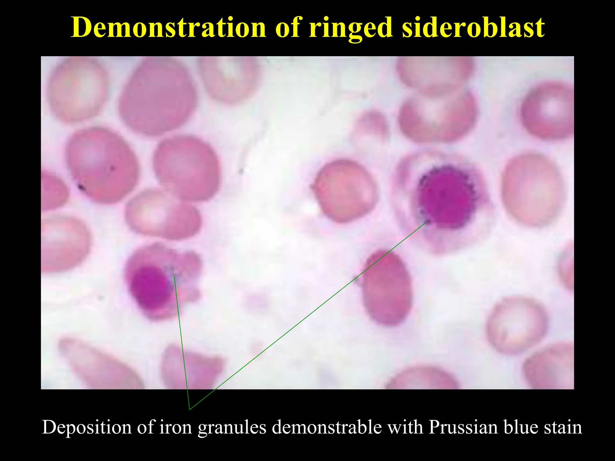 IRON METABOLISM & MICROCYTIC HYPOCHROMIC ANAEMIAS.pptx