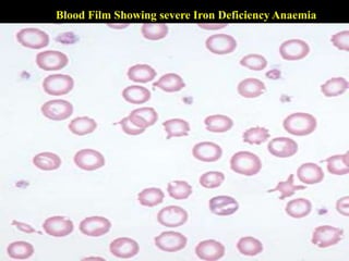 IRON METABOLISM & MICROCYTIC HYPOCHROMIC ANAEMIAS.pptx