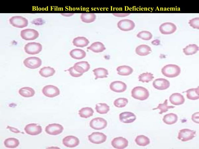 IRON METABOLISM & MICROCYTIC HYPOCHROMIC ANAEMIAS.pptx