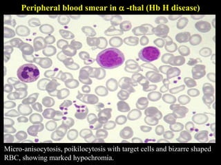 IRON METABOLISM & MICROCYTIC HYPOCHROMIC ANAEMIAS.pptx