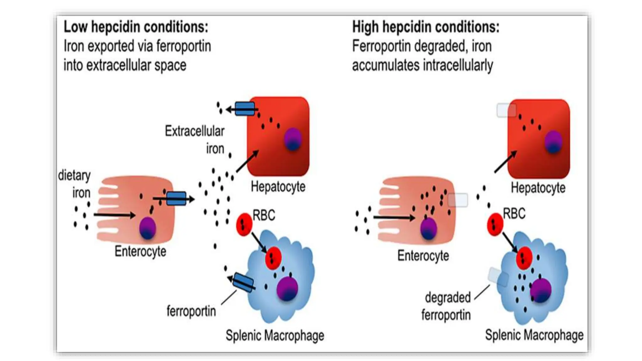 Iron Refractory Iron Deficiency Anemia.pptx