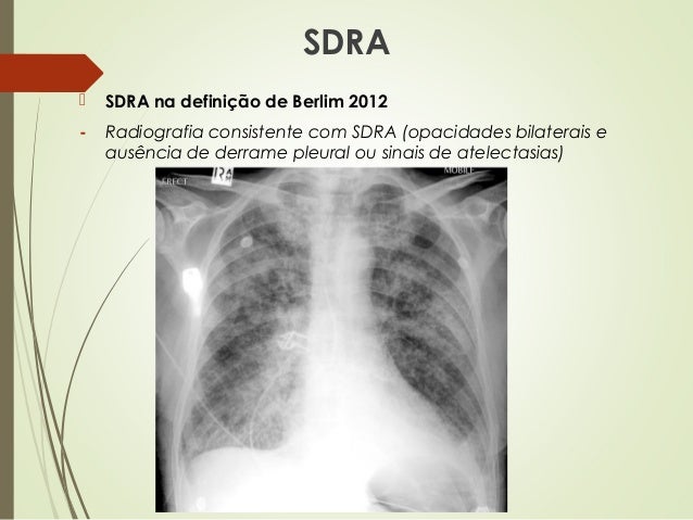 Insuficiência Respiratória Aguda (IRpA) e Síndrome do Desconforto Res…