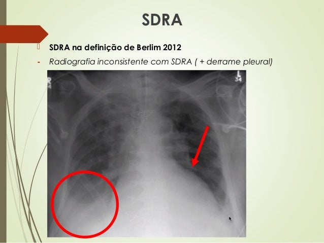 Insuficiência Respiratória Aguda (IRpA) e Síndrome do Desconforto Res…