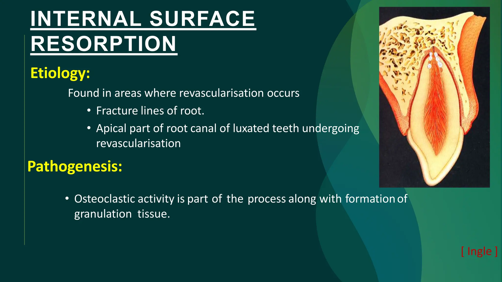 INTERNAL ROOT RESORPTION AND ITS CLINICAL MANAGEMENT | PPTX