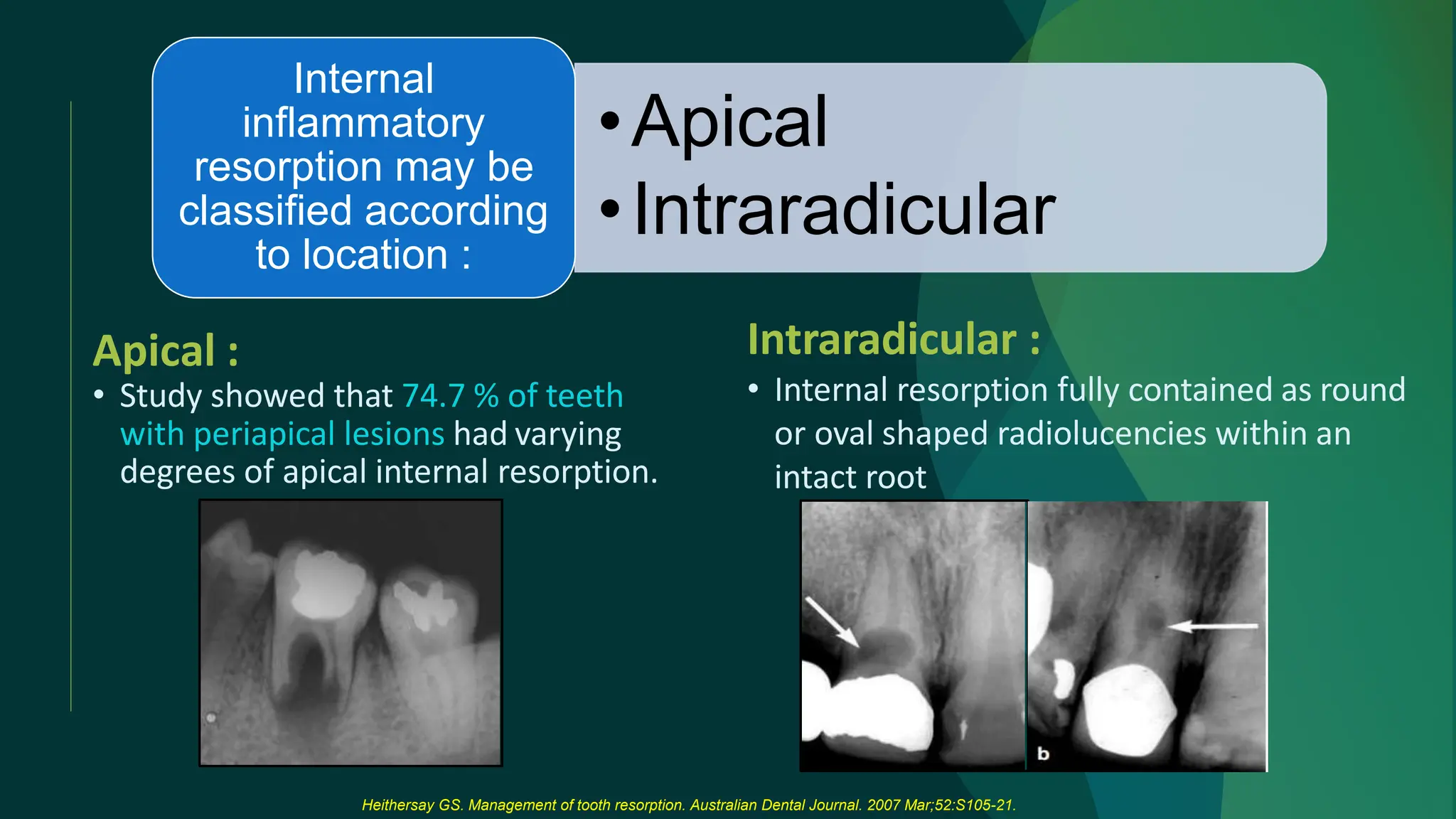 INTERNAL ROOT RESORPTION AND ITS CLINICAL MANAGEMENT | PPTX