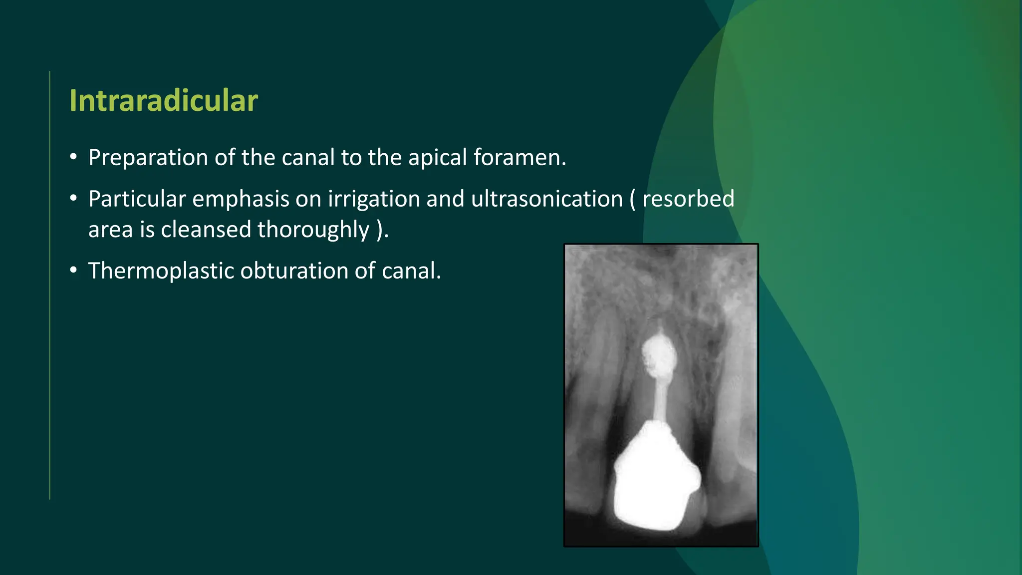 INTERNAL ROOT RESORPTION AND ITS CLINICAL MANAGEMENT | PPTX