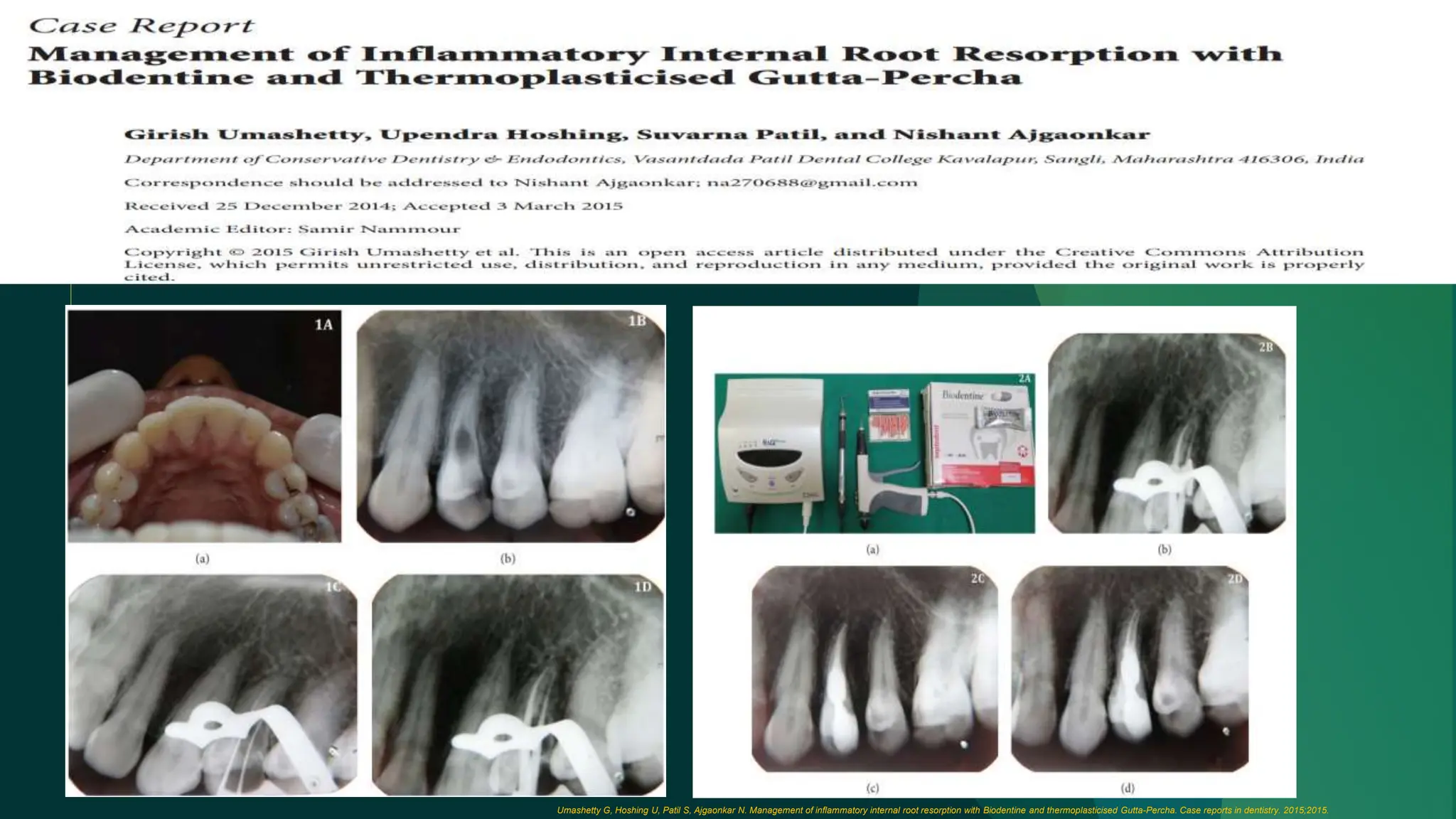 INTERNAL ROOT RESORPTION AND ITS CLINICAL MANAGEMENT | PPTX