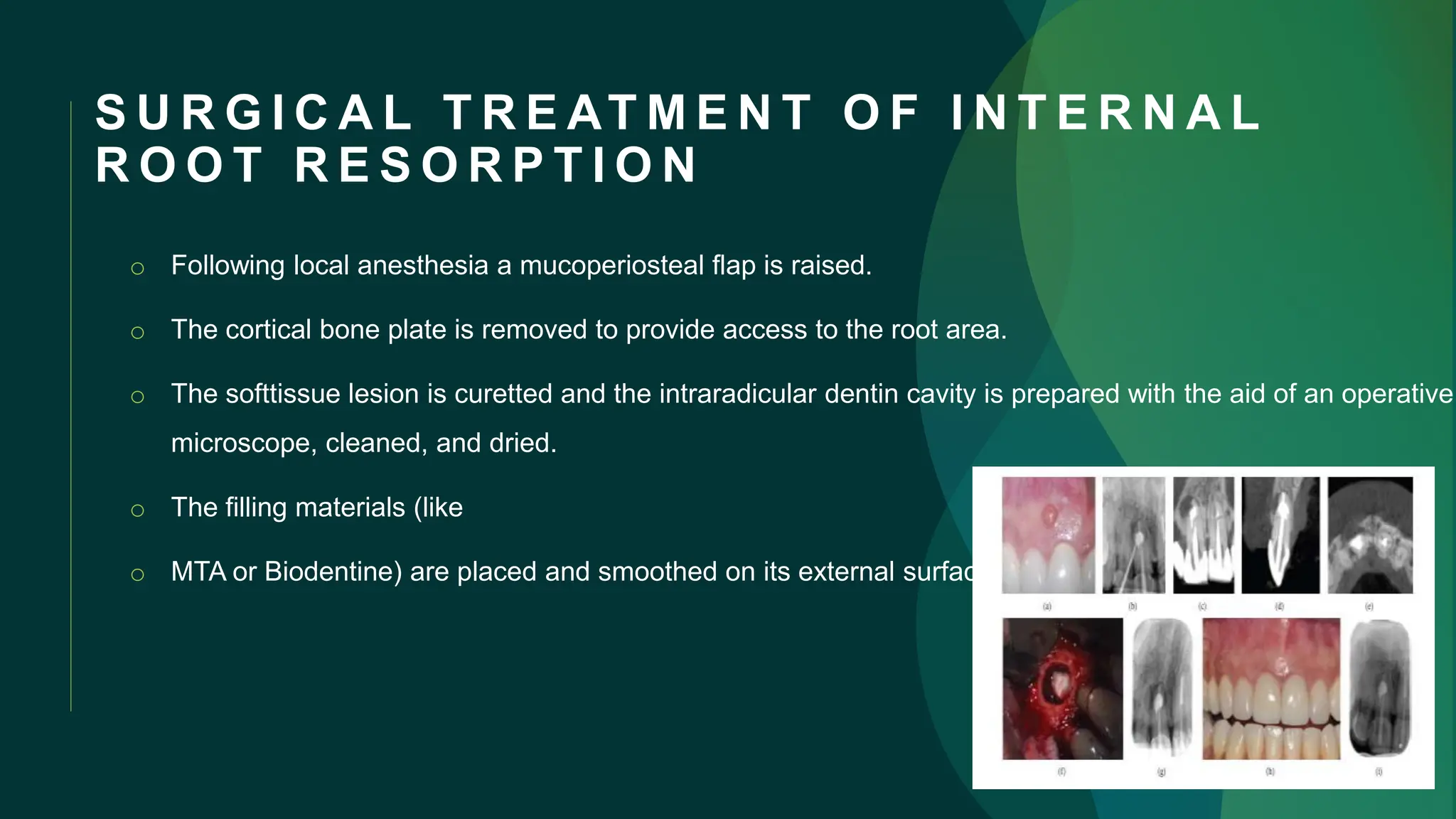 INTERNAL ROOT RESORPTION AND ITS CLINICAL MANAGEMENT | PPTX