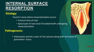 INTERNAL ROOT RESORPTION AND ITS CLINICAL MANAGEMENT | PPTX
