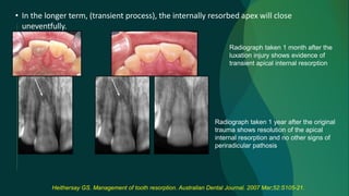 INTERNAL ROOT RESORPTION AND ITS CLINICAL MANAGEMENT | PPTX