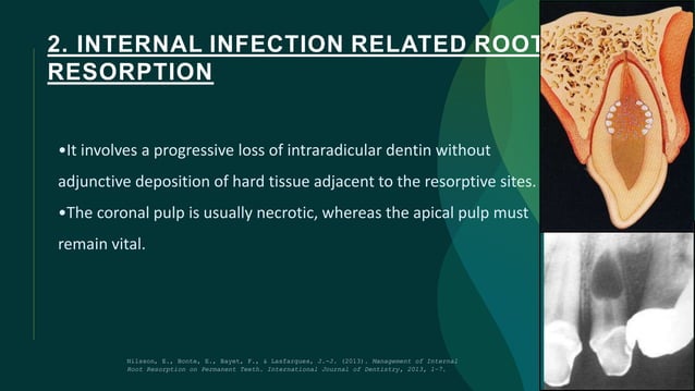 INTERNAL ROOT RESORPTION AND ITS CLINICAL MANAGEMENT | PPTX | Dental ...
