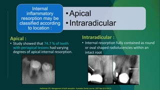 INTERNAL ROOT RESORPTION AND ITS CLINICAL MANAGEMENT | PPTX