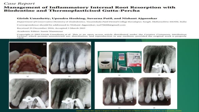 INTERNAL ROOT RESORPTION AND ITS CLINICAL MANAGEMENT | PPTX | Dental ...