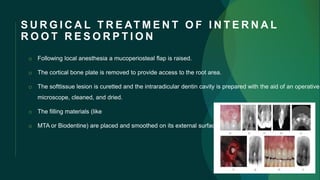 INTERNAL ROOT RESORPTION AND ITS CLINICAL MANAGEMENT | PPTX