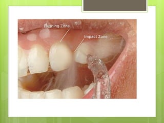 SUPRAGINGIVAL AND SUBGINGIVAL IRRIGATION | PPTX