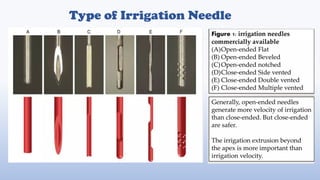 Irrigation Solutions in Endodontics: Types, Techniques, and Best ...