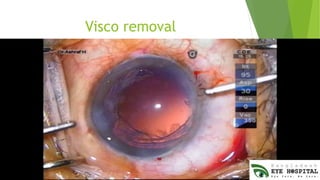 Irrigation and Aspiration in Phacoemulsification | PPTX