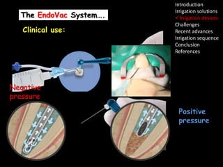 Irrigation in endodontics | PPTX