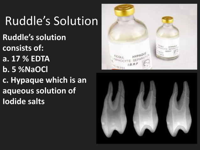 Endodontic Irrigation and root canal medicament the new methods of ...