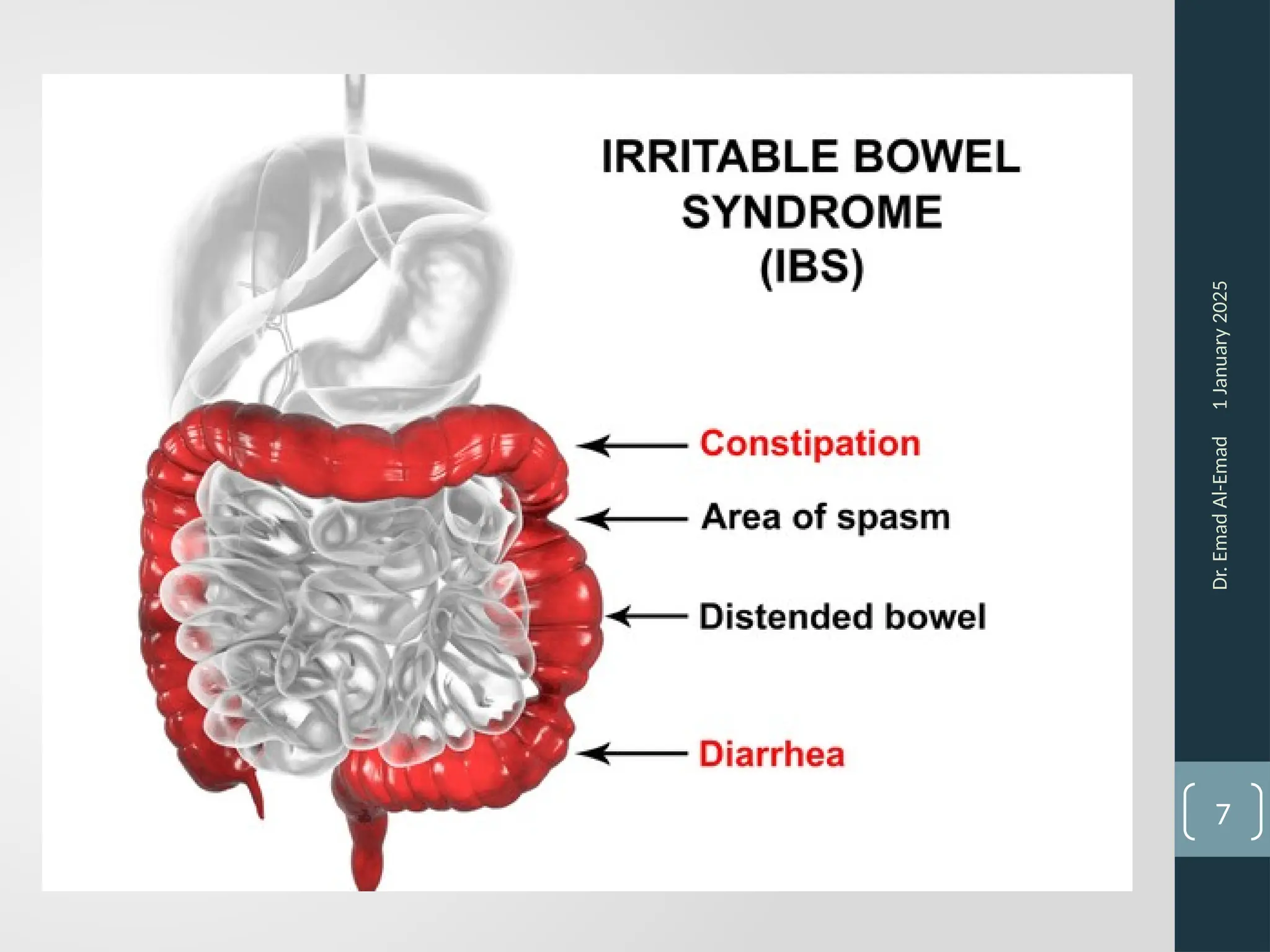 Irritable bowel syndrome ( IBS ) - for medical student | PPTX