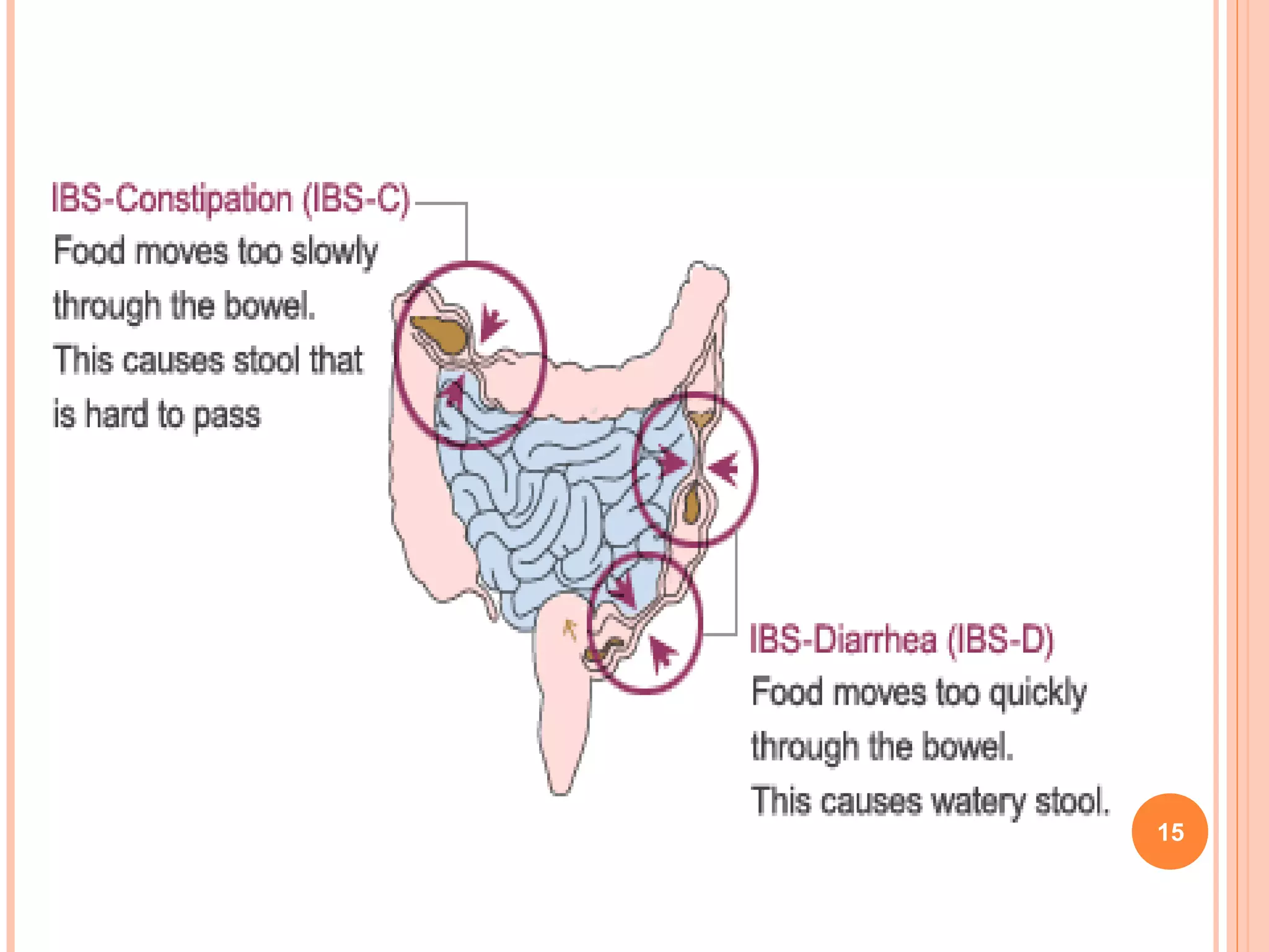 Irritable bowel syndrome | PPT